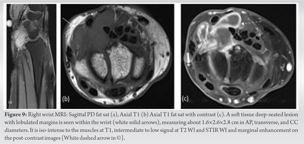 Secondary Chondrosarcoma Arising in Synovial Chondromatosis of Wrist ...