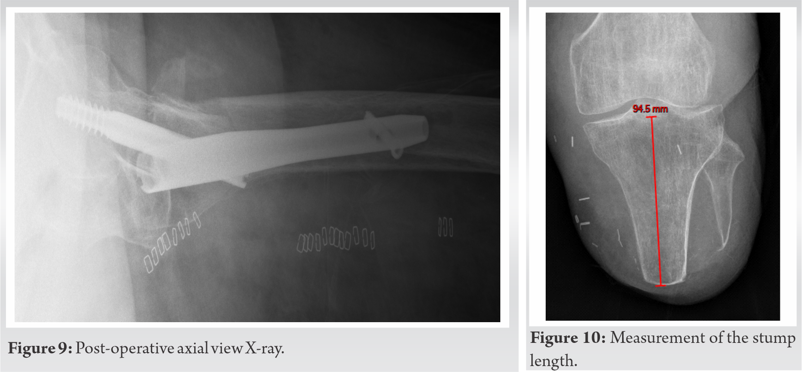 A new non-invasive method for positioning a below-knee amputee with an ...