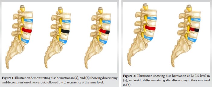 Analogy of Lumbar Disc: Retained, Residual, or Recurrent Disc ...