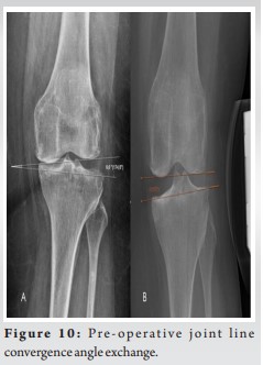 A Rare Complication: Severe Valgus Deformity After Open-Wedge High ...