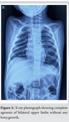 Isolated Bilateral Upper Limb Amelia – A Rare Case Report | Journal of ...