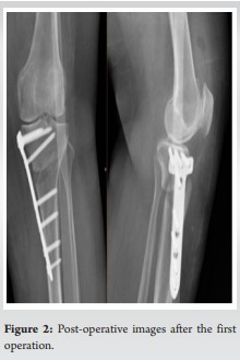 A Rare Complication: Severe Valgus Deformity After Open-Wedge High ...