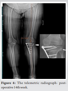 A Rare Complication: Severe Valgus Deformity After Open-Wedge High ...
