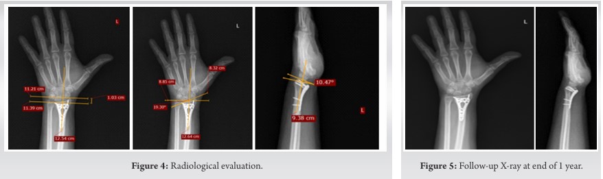 Clinicoradiological Outcome of Variable Angle Volar Locking Plate in ...