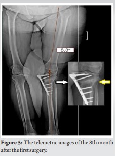 A Rare Complication: Severe Valgus Deformity After Open-Wedge High ...
