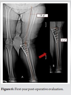 A Rare Complication: Severe Valgus Deformity After Open-Wedge High ...