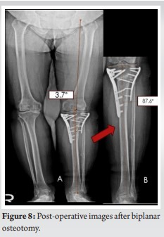 A Rare Complication: Severe Valgus Deformity After Open-Wedge High ...