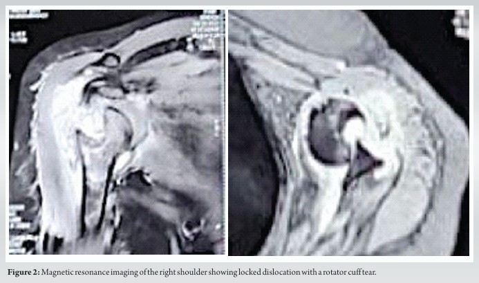 Management of Neglected Locked Anterior Shoulder Dislocation in the ...