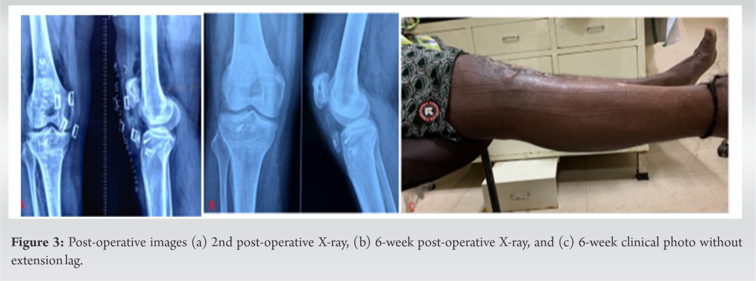Management of Neglected Patellar Tendon Rupture by Peroneus Longus ...