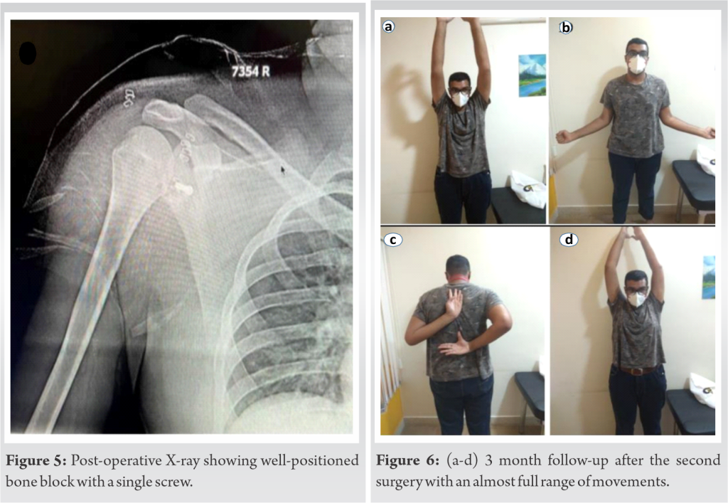 Arthroscopic Salvage Procedure for Iatrogenic Conjoint Tendon Avulsion ...