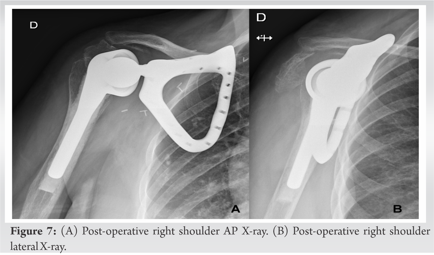 Total Scapular Prosthesis, an Option for the Treatment of Scapular ...
